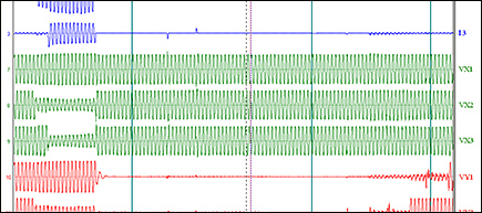 Interruptor de Falta IntelliRupter® PulseCloser®